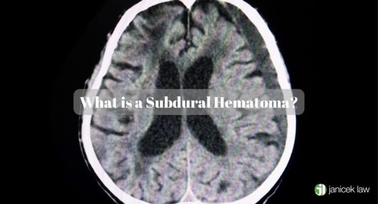 What is a Subdural Hematoma? | Janicek Law