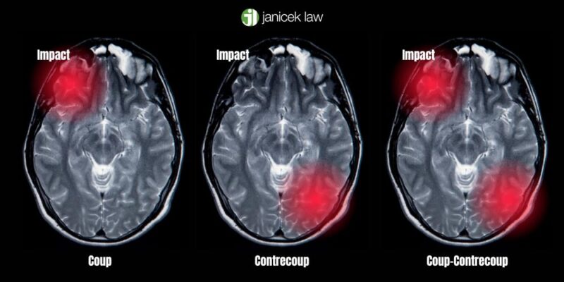 Coup Contrecoup Injury San Antonio | Coup and Contrecoup